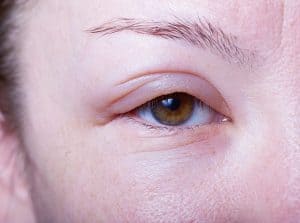 Roche bags Eleven’s experimental eye disease drug - PharmaTimes