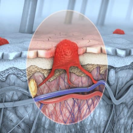 MHRA approves new treatment for severe alopecia areata - PharmaTimes
